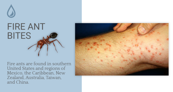 Bites and Stings - The Dermatology Specialists