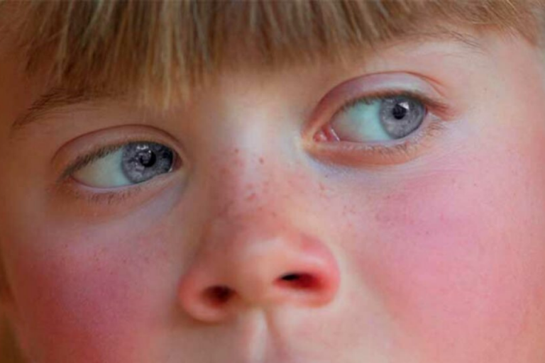 Rosacea Treatments - The Dermatology Specialists