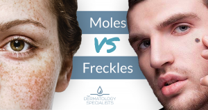 How to Tell the Difference Between a Mole and a Freckle - The ...