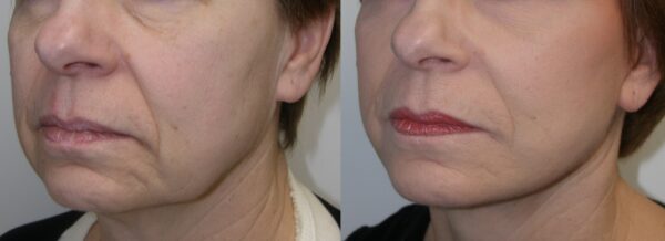 What Kind of Laser is best for a Sagging Neck & Jowls? - The ...