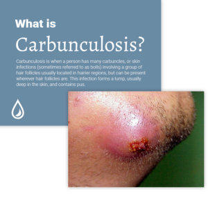 Carbunculosis: Causes and Effective Treatment Options - The Dermatology ...