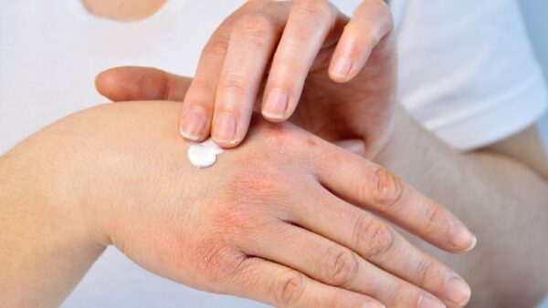 You can develop "hard skin" - The Dermatology Specialists