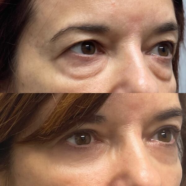 Lower Blepharoplasty - The Dermatology Specialists